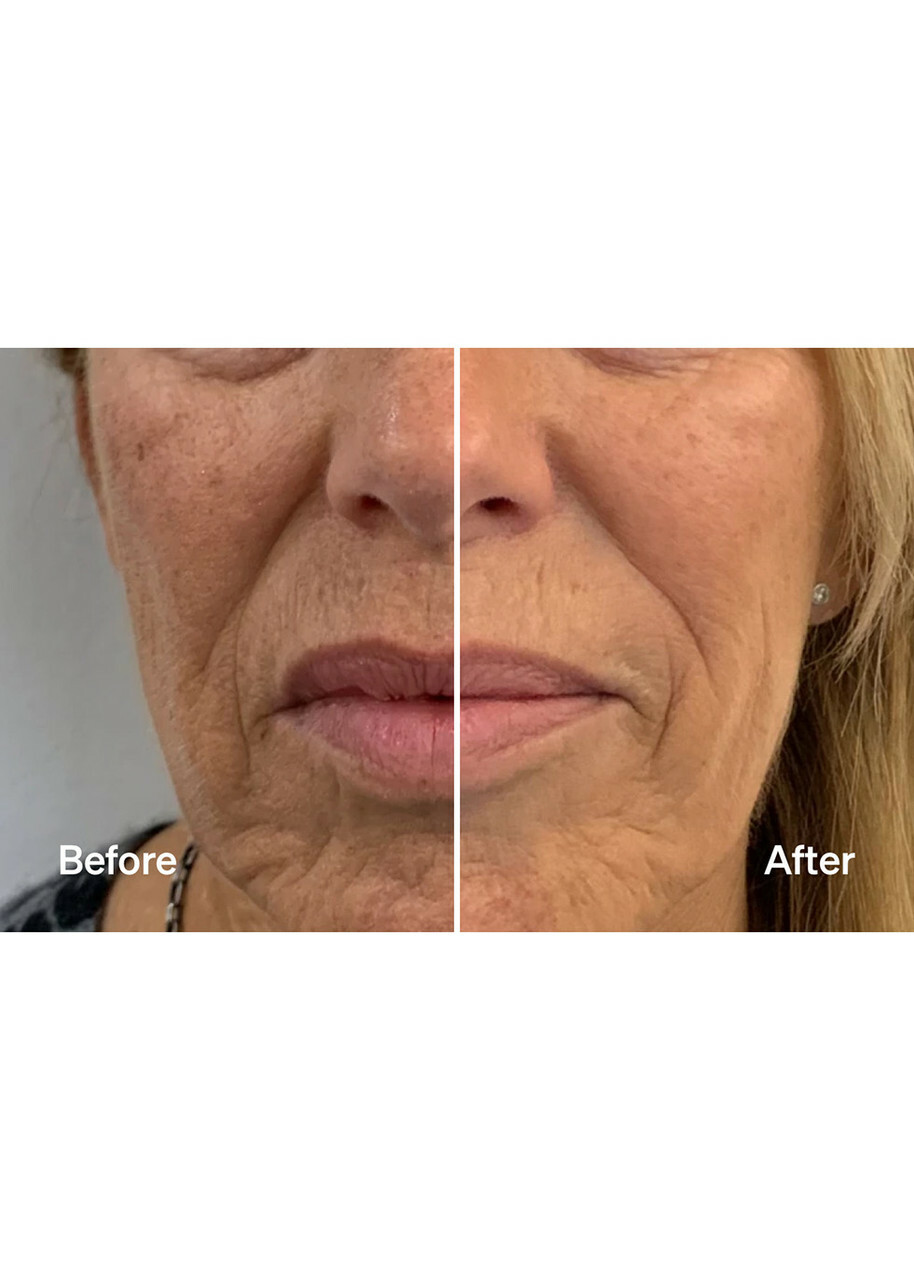 Lyma Laser Starter Kit - Lightweight & Hand-held LYMA